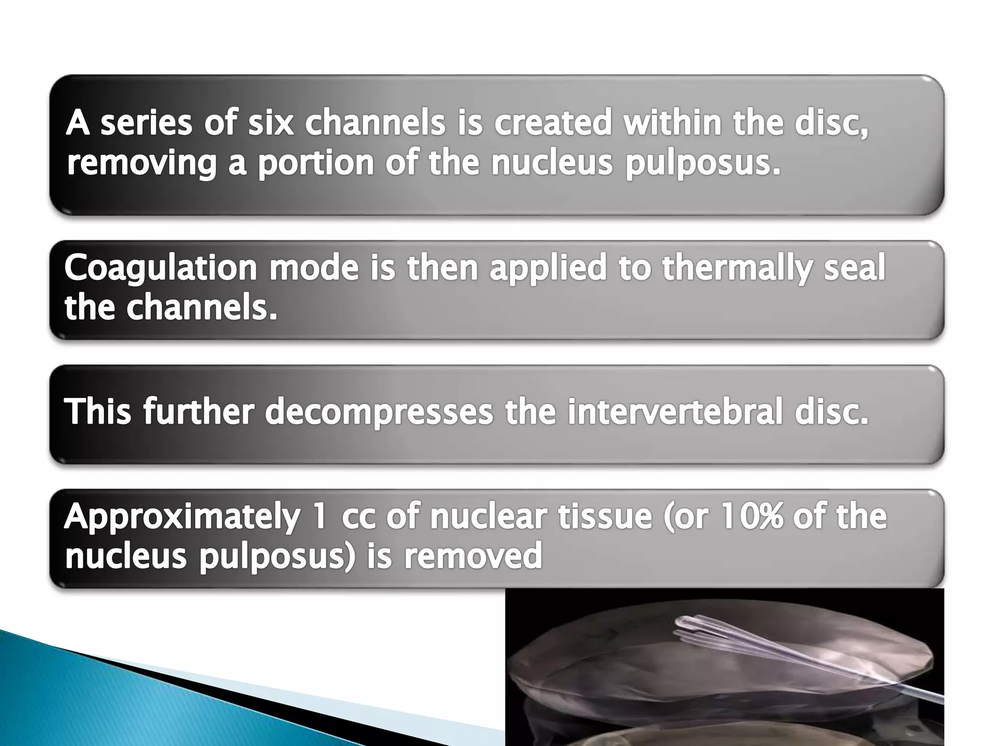 Percutaneous coblation disc nucleoplasty | PPTX