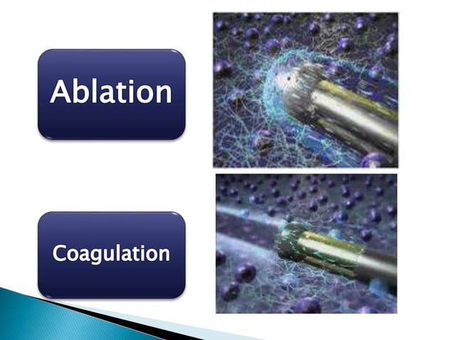 Percutaneous coblation disc nucleoplasty | PPT