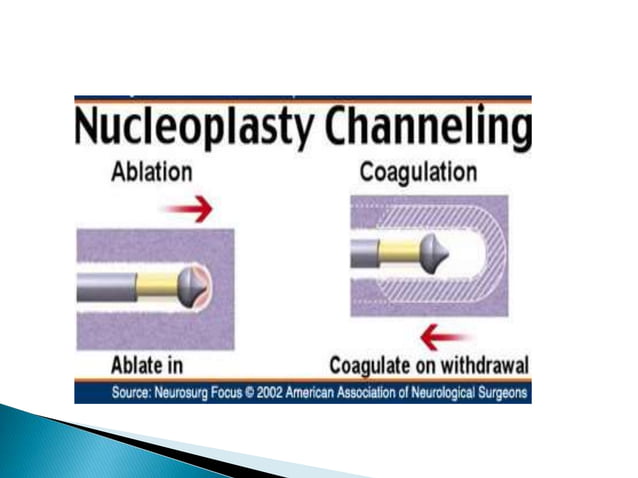 Percutaneous coblation disc nucleoplasty | PPT