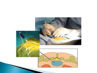 Percutaneous coblation disc nucleoplasty | PPTX