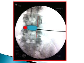 Percutaneous coblation disc nucleoplasty | PPTX