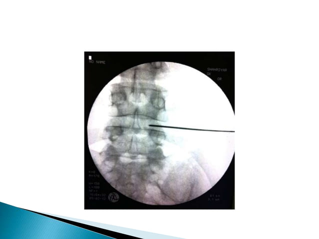Percutaneous coblation disc nucleoplasty | PPT