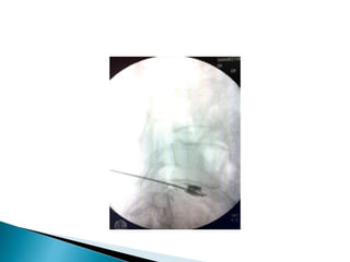 Percutaneous coblation disc nucleoplasty | PPTX