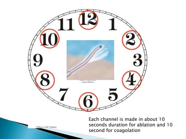 Percutaneous coblation disc nucleoplasty | PPT