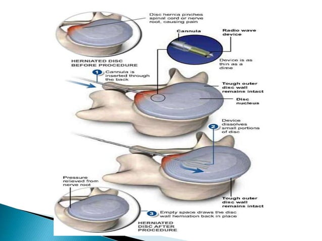 Percutaneous coblation disc nucleoplasty | PPT
