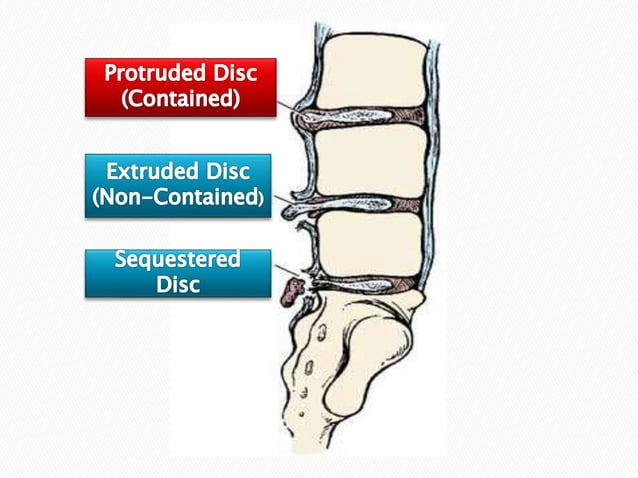 Percutaneous coblation disc nucleoplasty | PPT