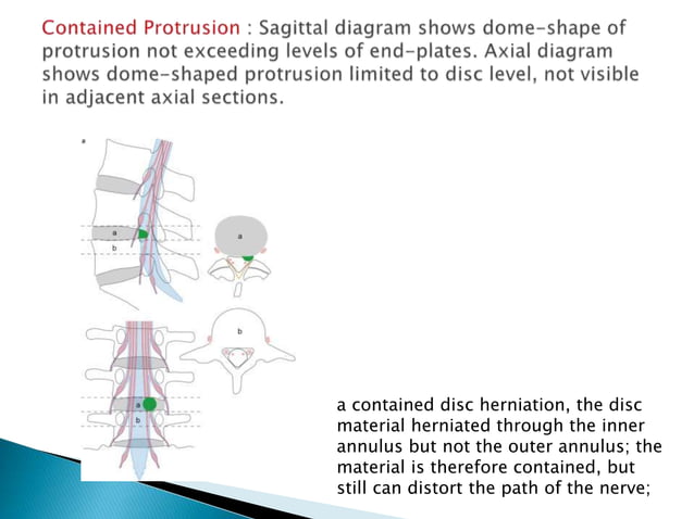 Percutaneous coblation disc nucleoplasty | PPT