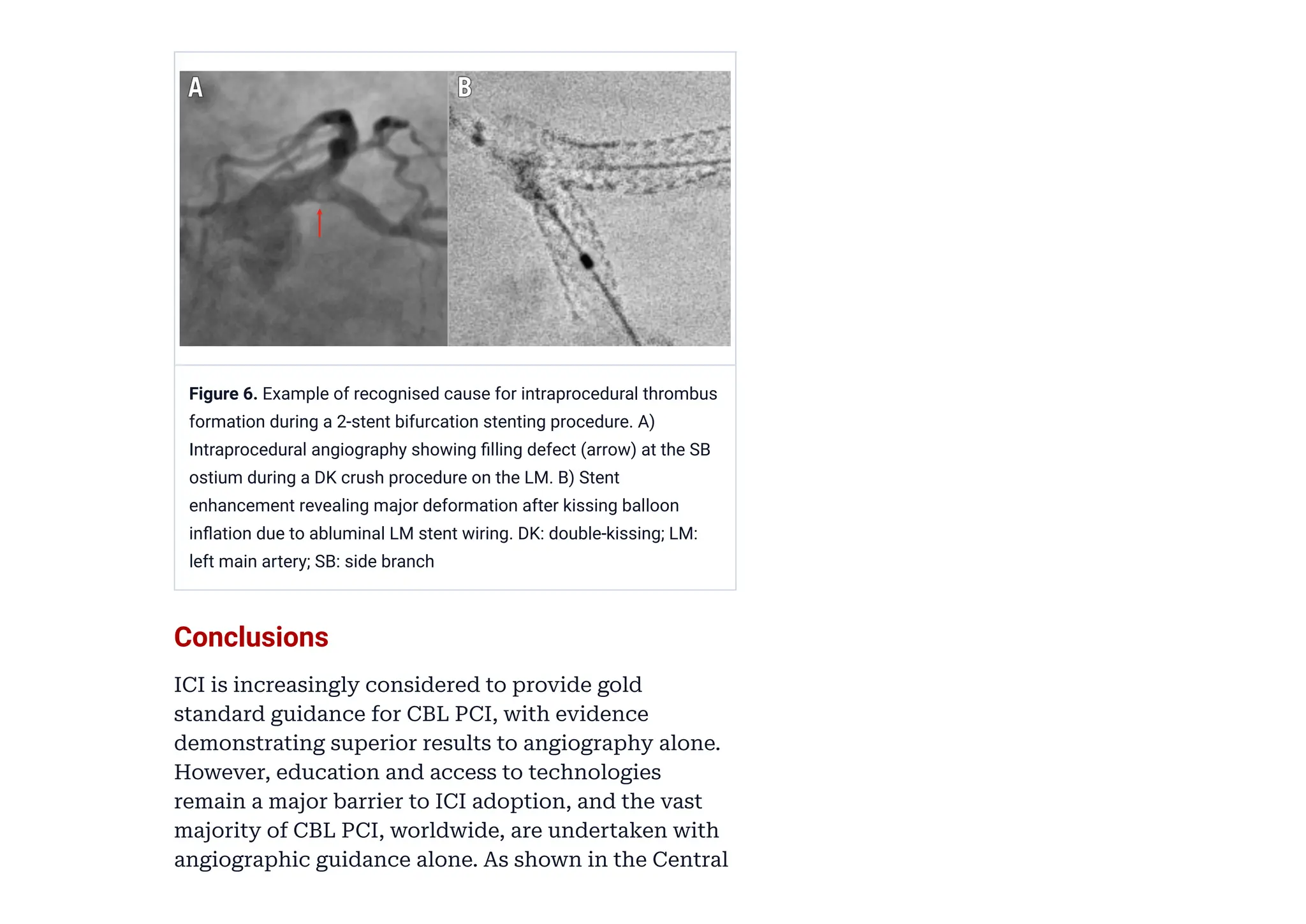 Percutaneous coronary intervention for bifurcation coronary lesions ...
