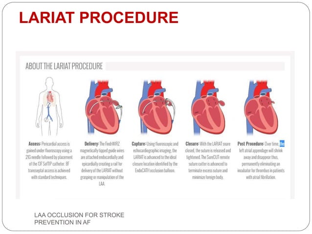 Percutaneous left atrial appendage | PPTX