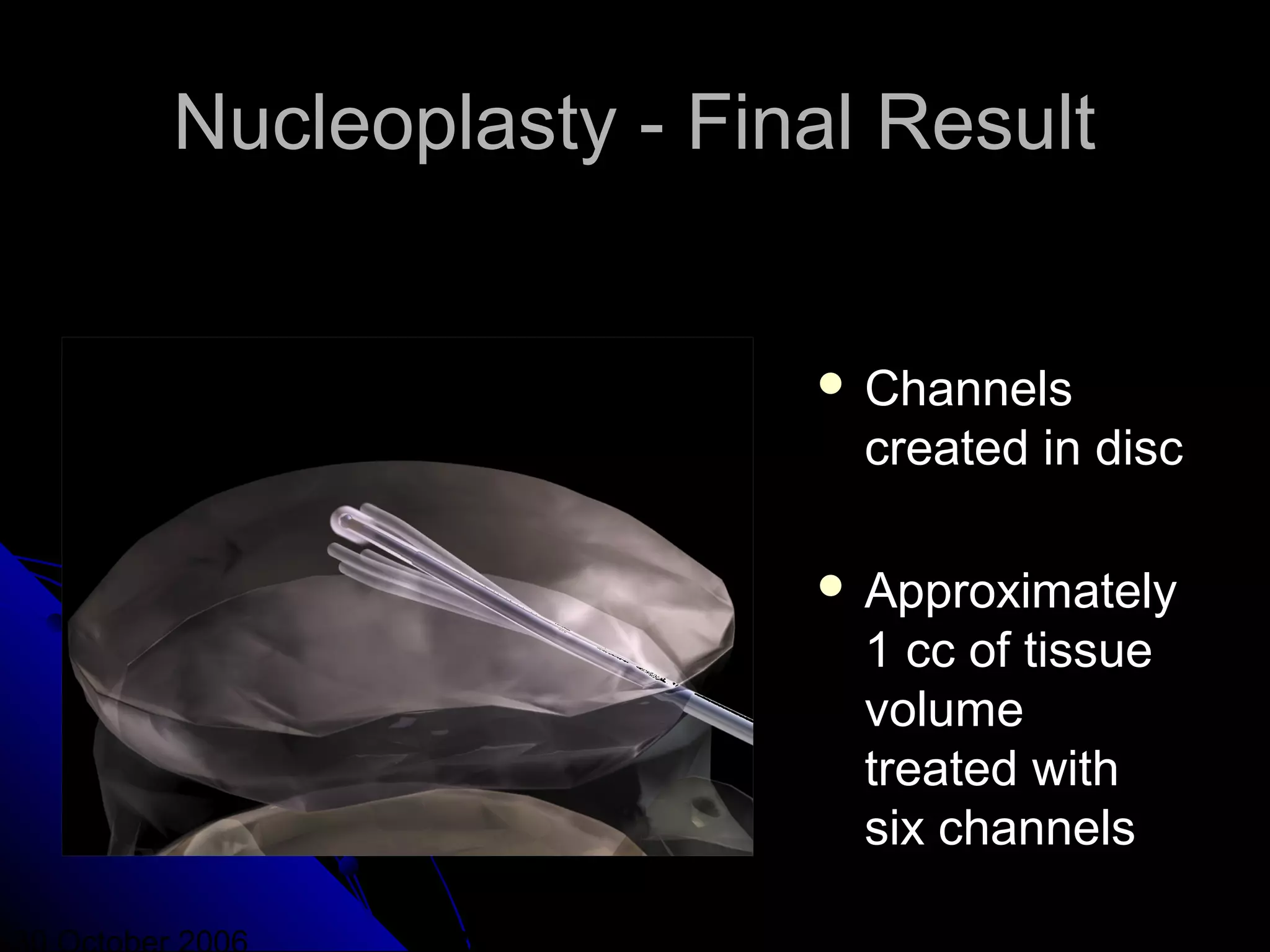Percutaneous lumbar nucleoplasty | PPT