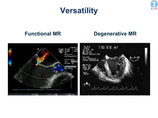 Percutaneous Mitral Repair The Truth | PPT
