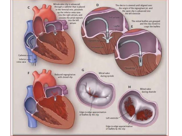 Percutaneous mitral valve interventions (repair) | PPTX | Heart and Cardiovascular Diseases ...