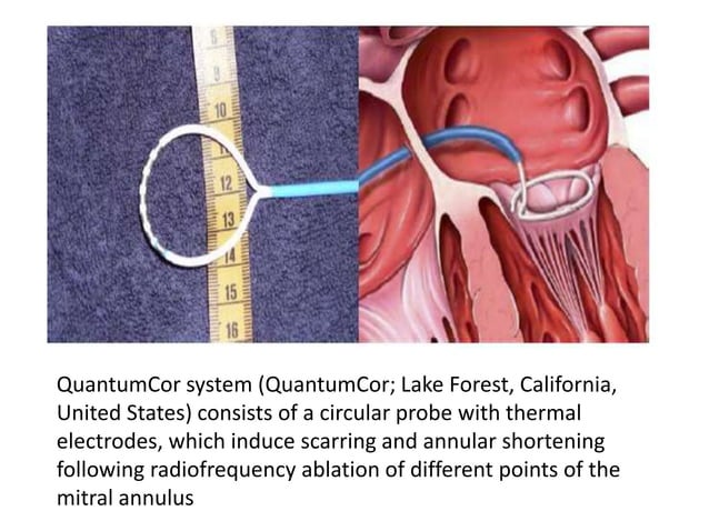 Percutaneous mitral valve interventions (repair) | PPTX | Heart and ...