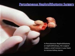 Percutaneous nephrolithotomy surgery india | PPTX