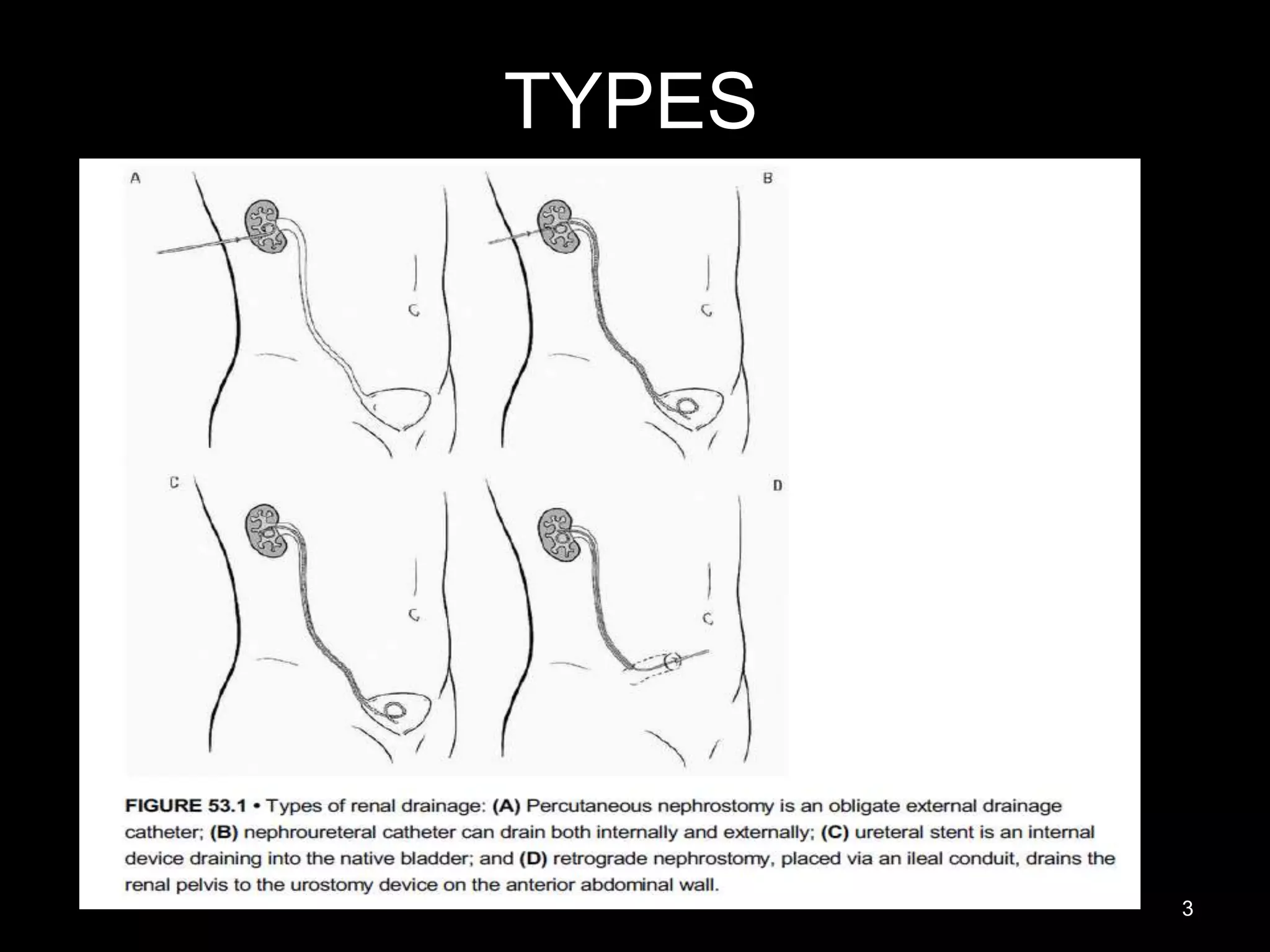 Percutaneous nephrostomy | PPTX