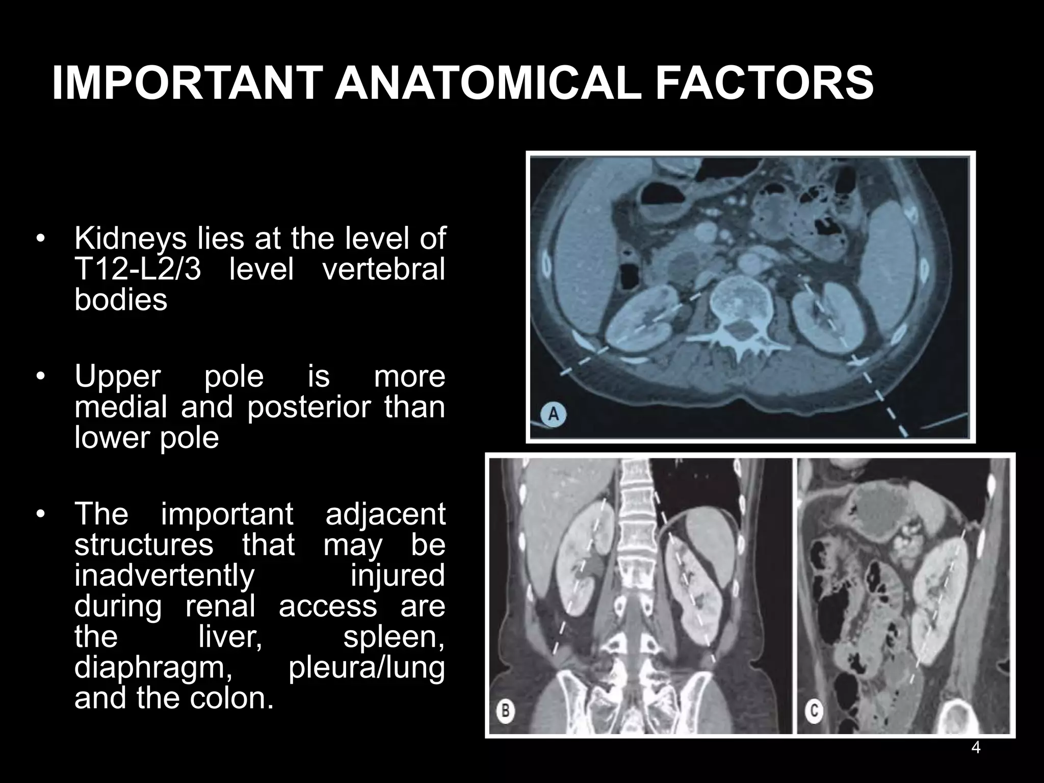 Percutaneous nephrostomy | PPTX
