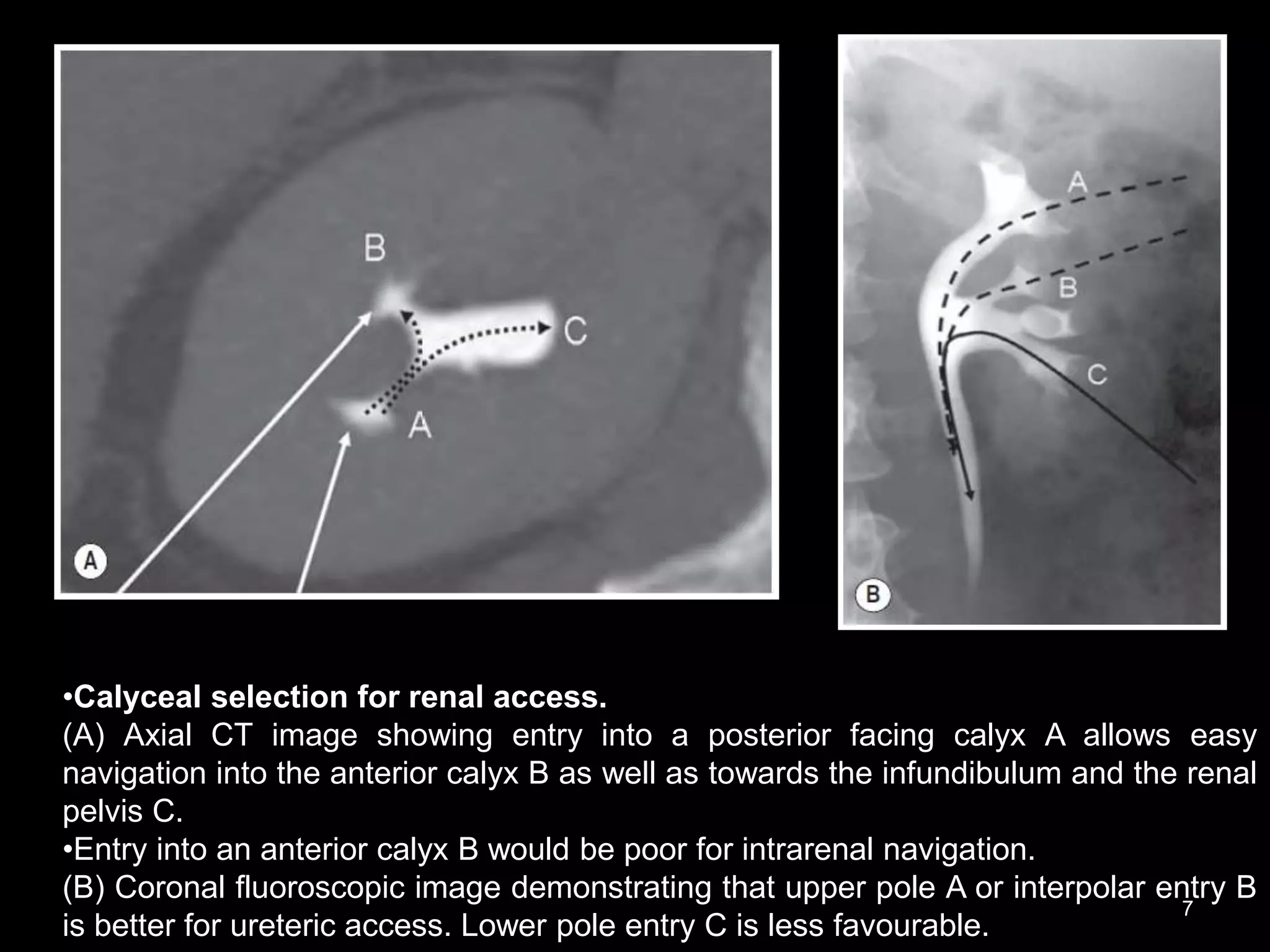 Percutaneous nephrostomy | PPTX