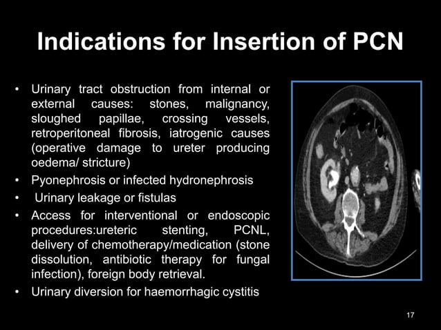 Percutaneous nephrostomy | PPTX