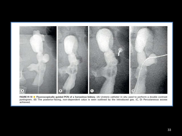 Percutaneous nephrostomy | PPTX