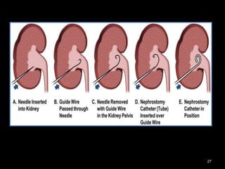 Nephrostomy Location