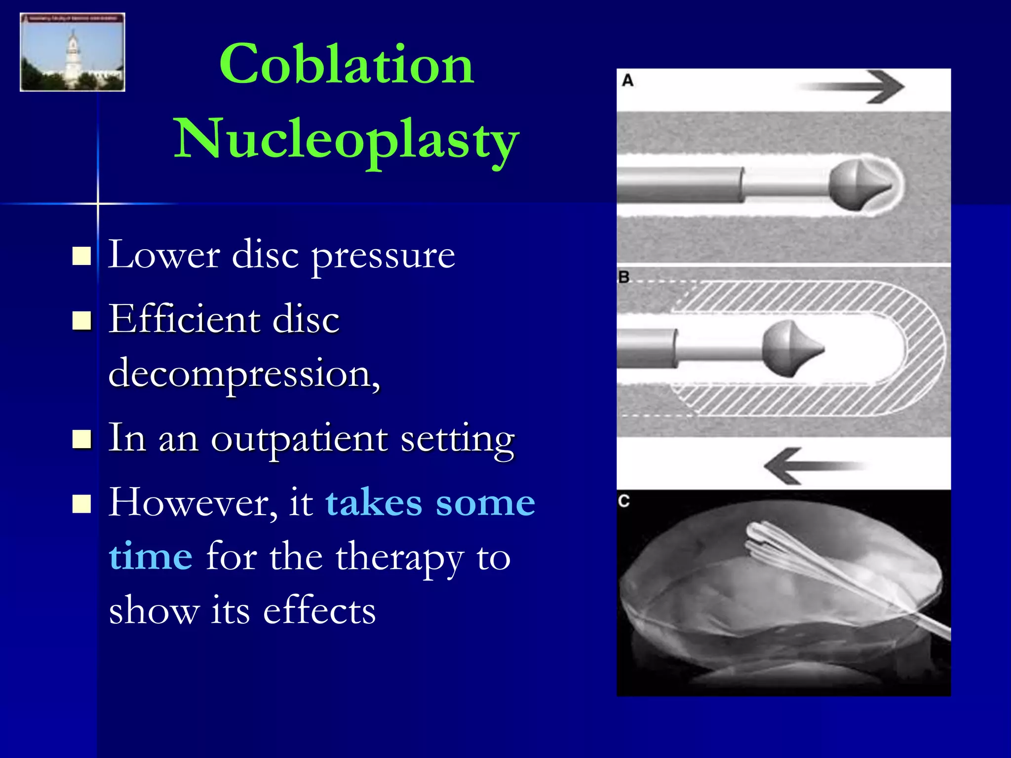Percutaneous nucleoplasty | PPSX