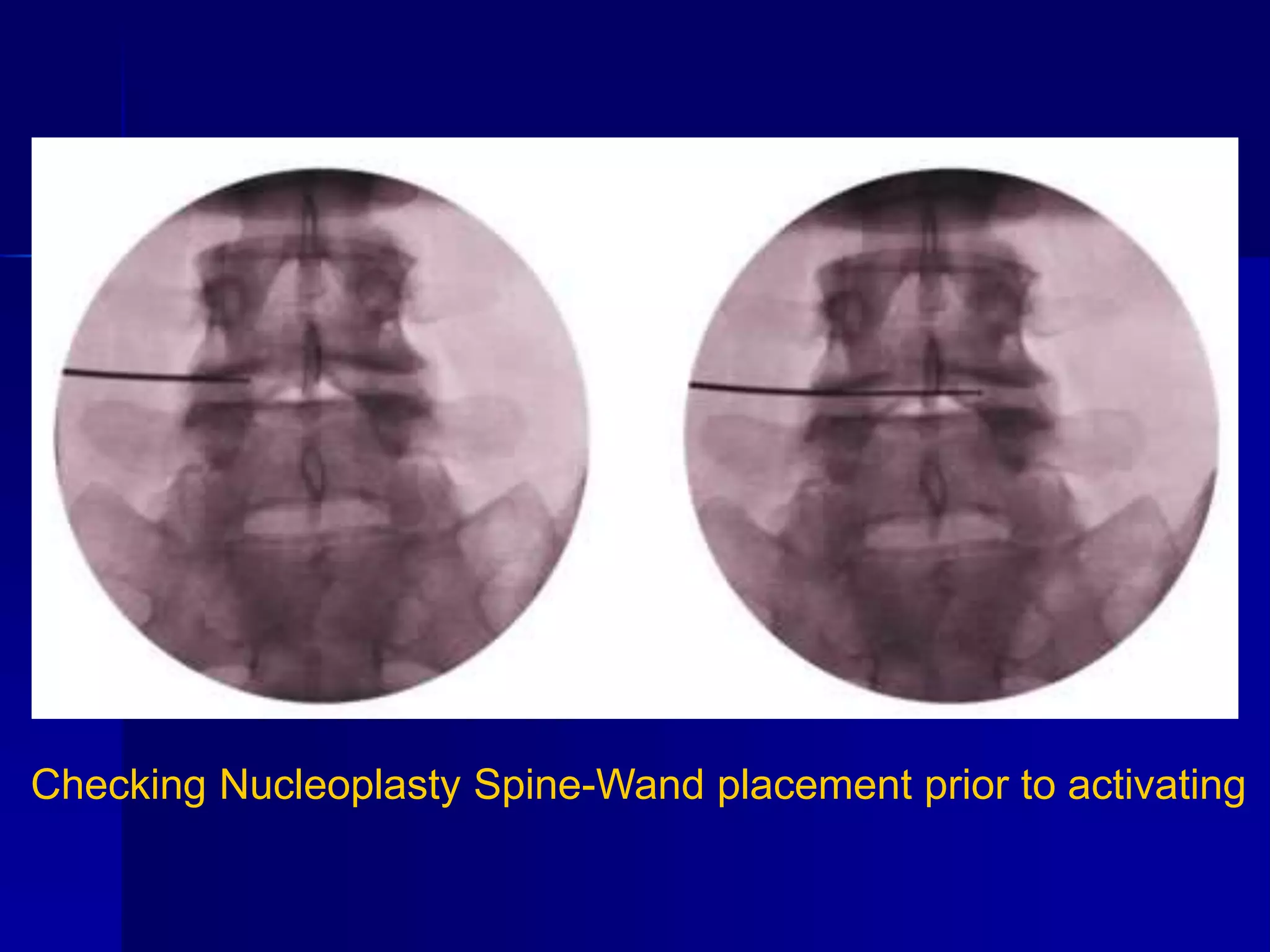 Percutaneous nucleoplasty | PPSX