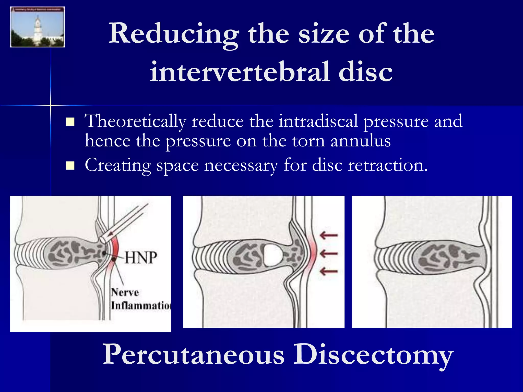 Percutaneous nucleoplasty | PPSX