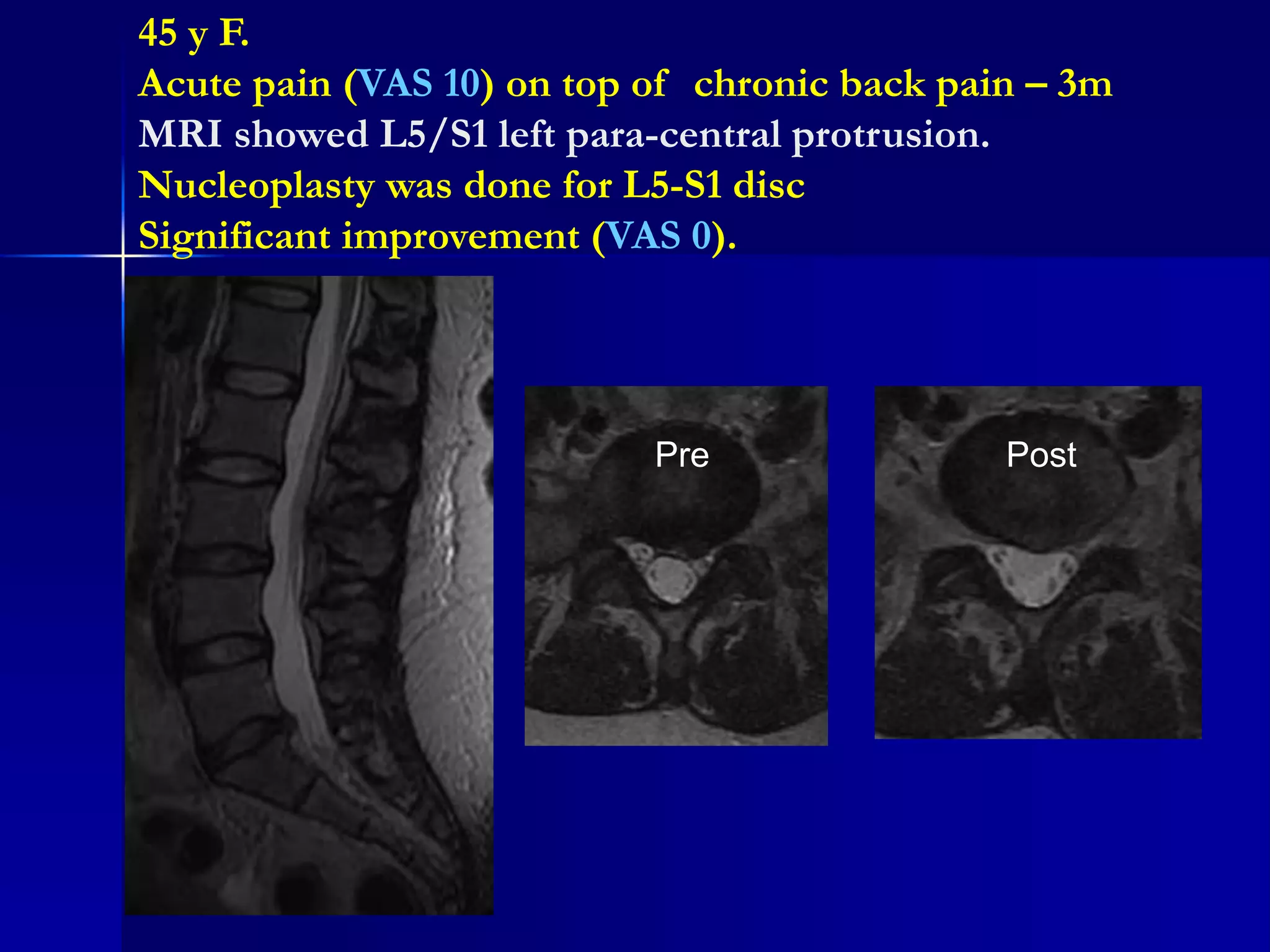 Percutaneous nucleoplasty | PPSX
