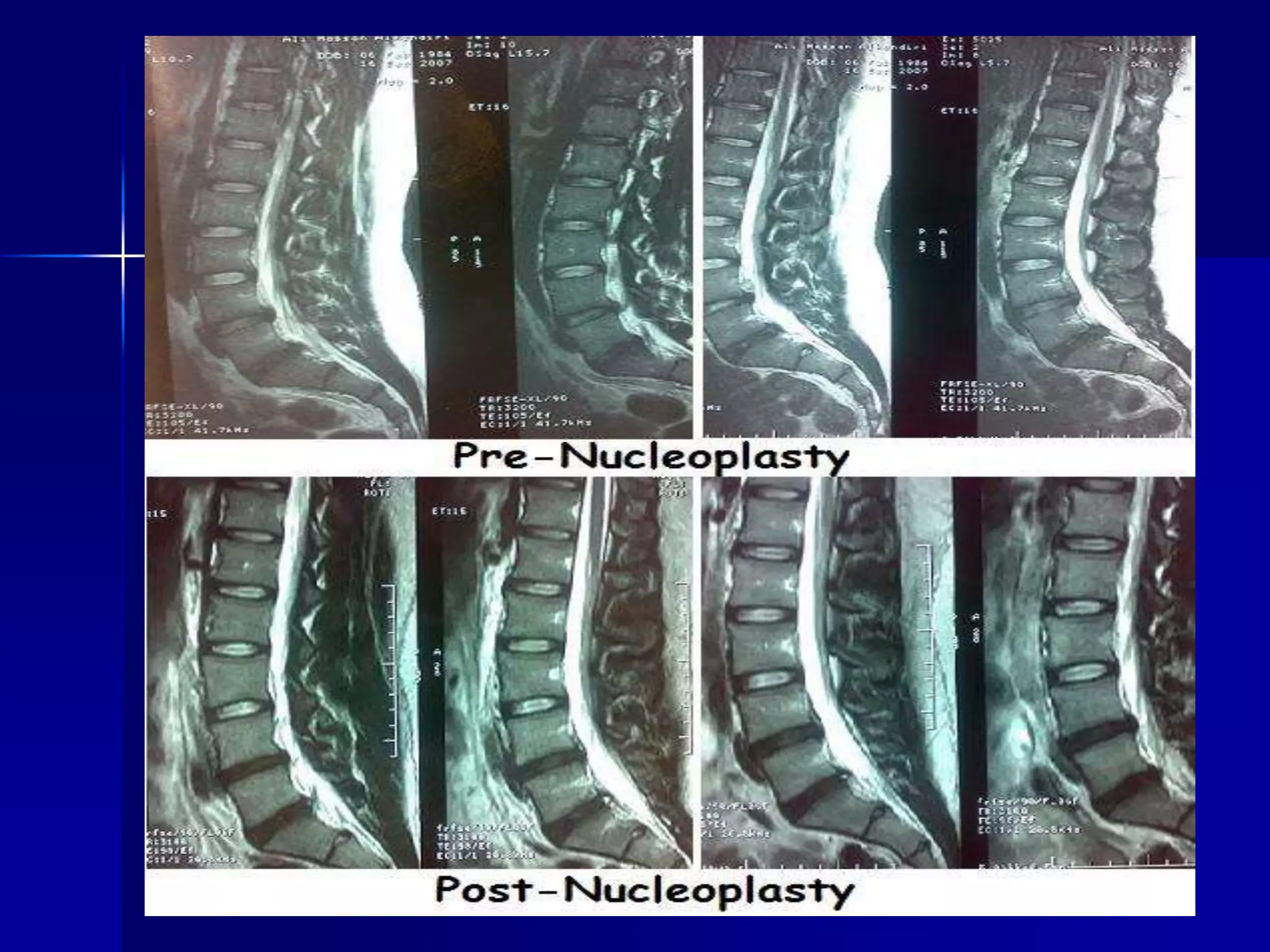 Percutaneous nucleoplasty | PPSX