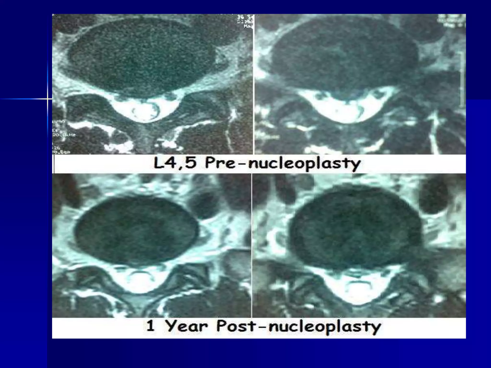 Percutaneous nucleoplasty | PPSX