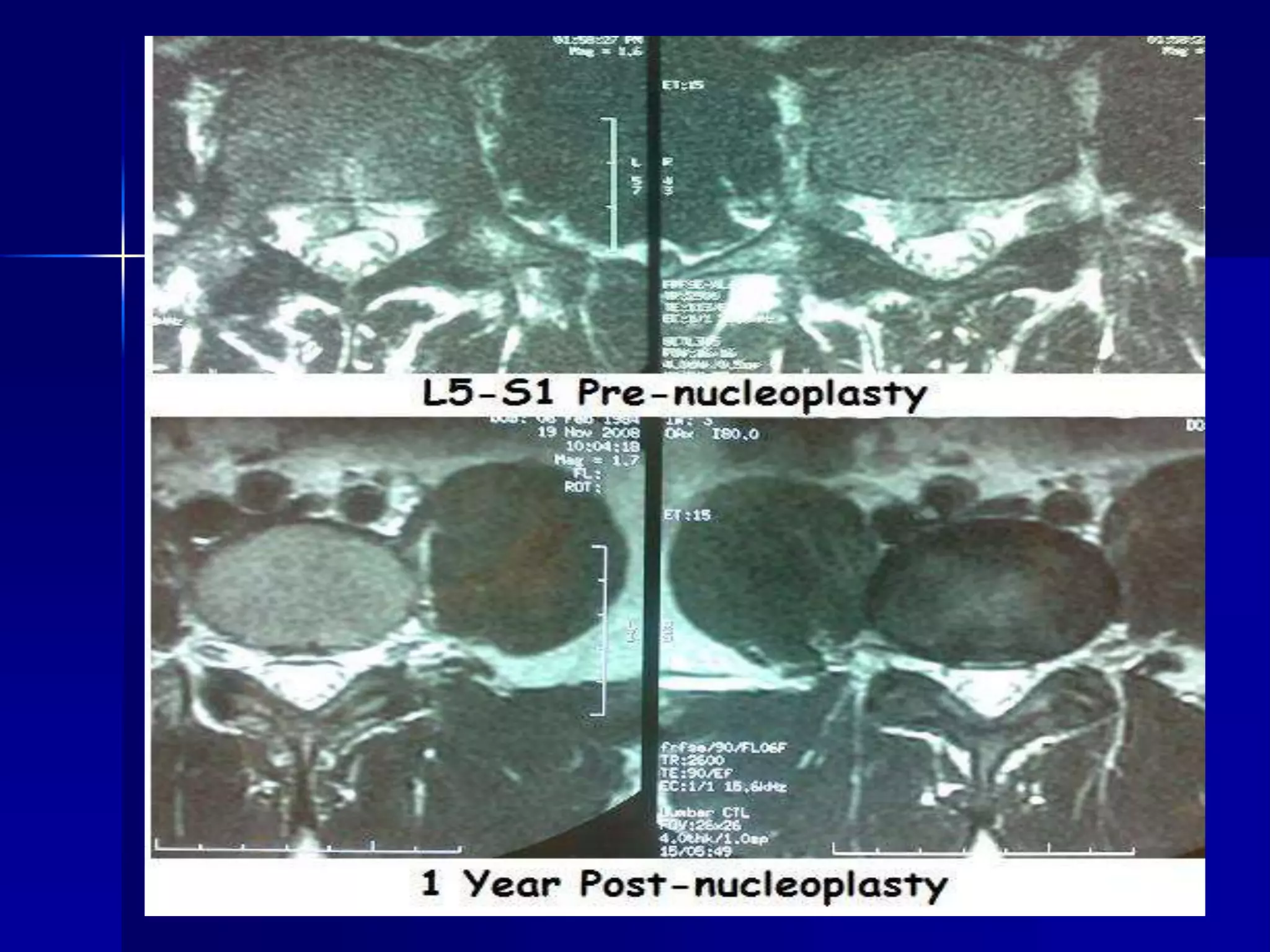 Percutaneous nucleoplasty | PPSX