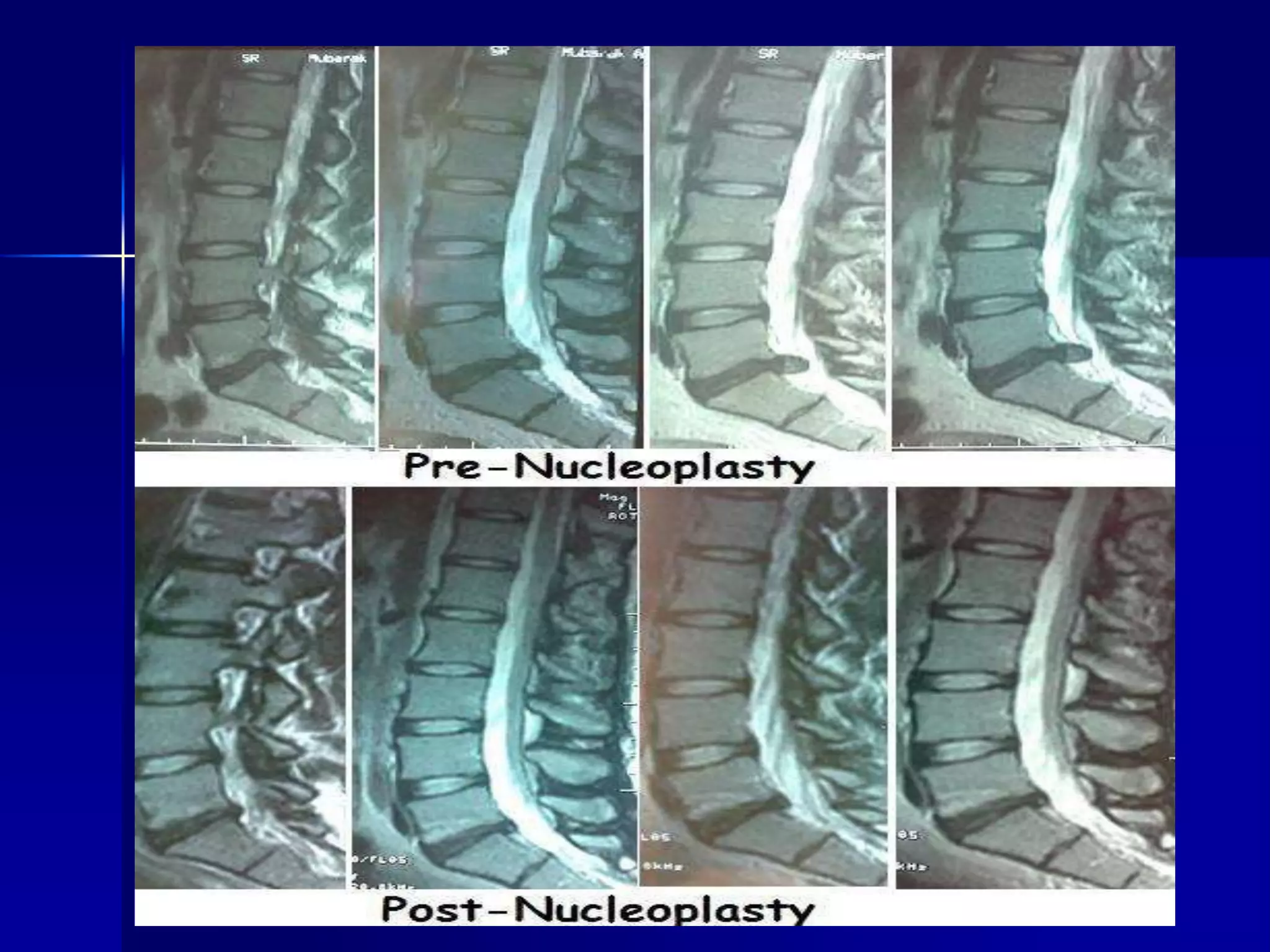 Percutaneous nucleoplasty | PPSX