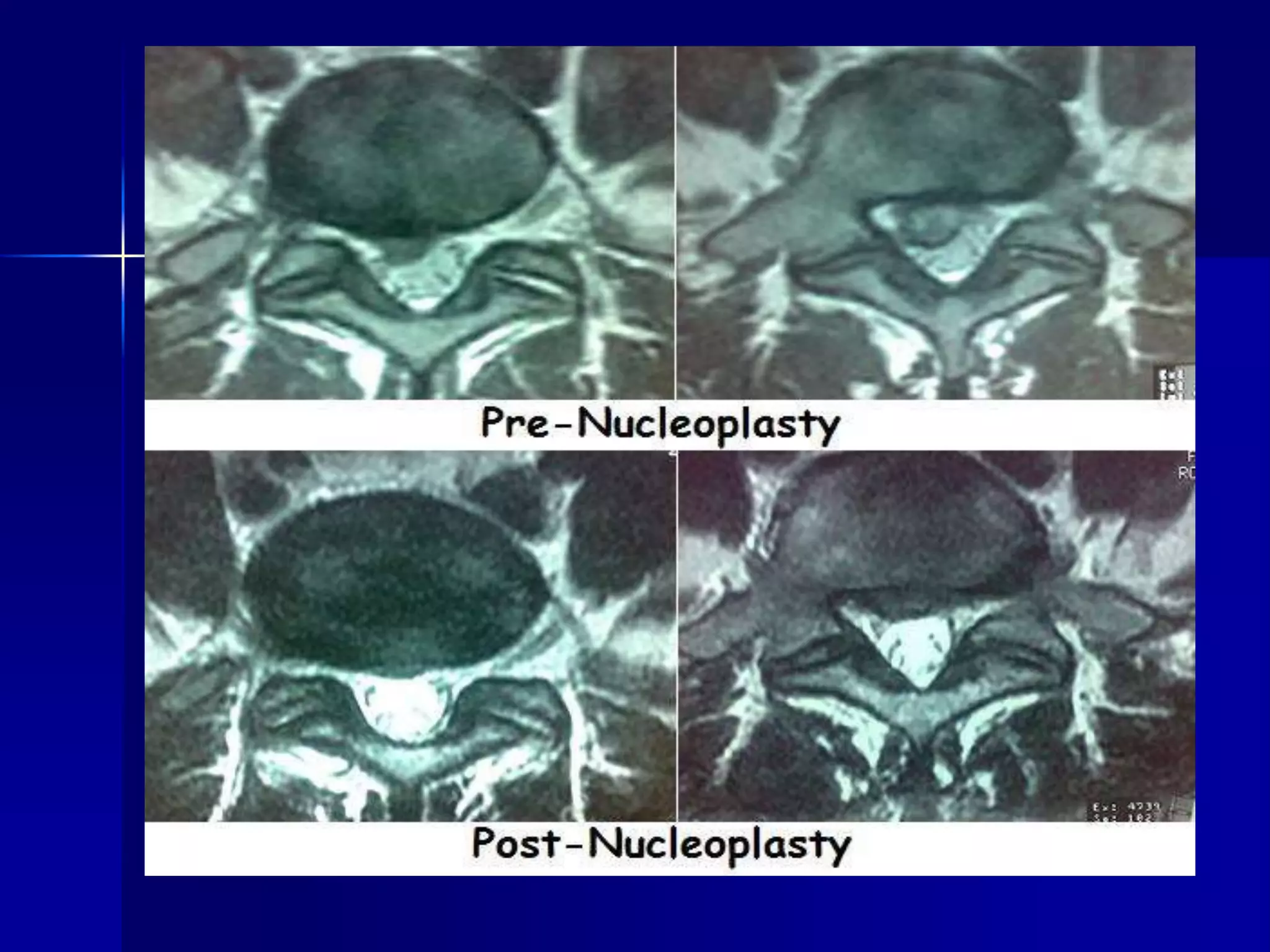 Percutaneous nucleoplasty | PPSX