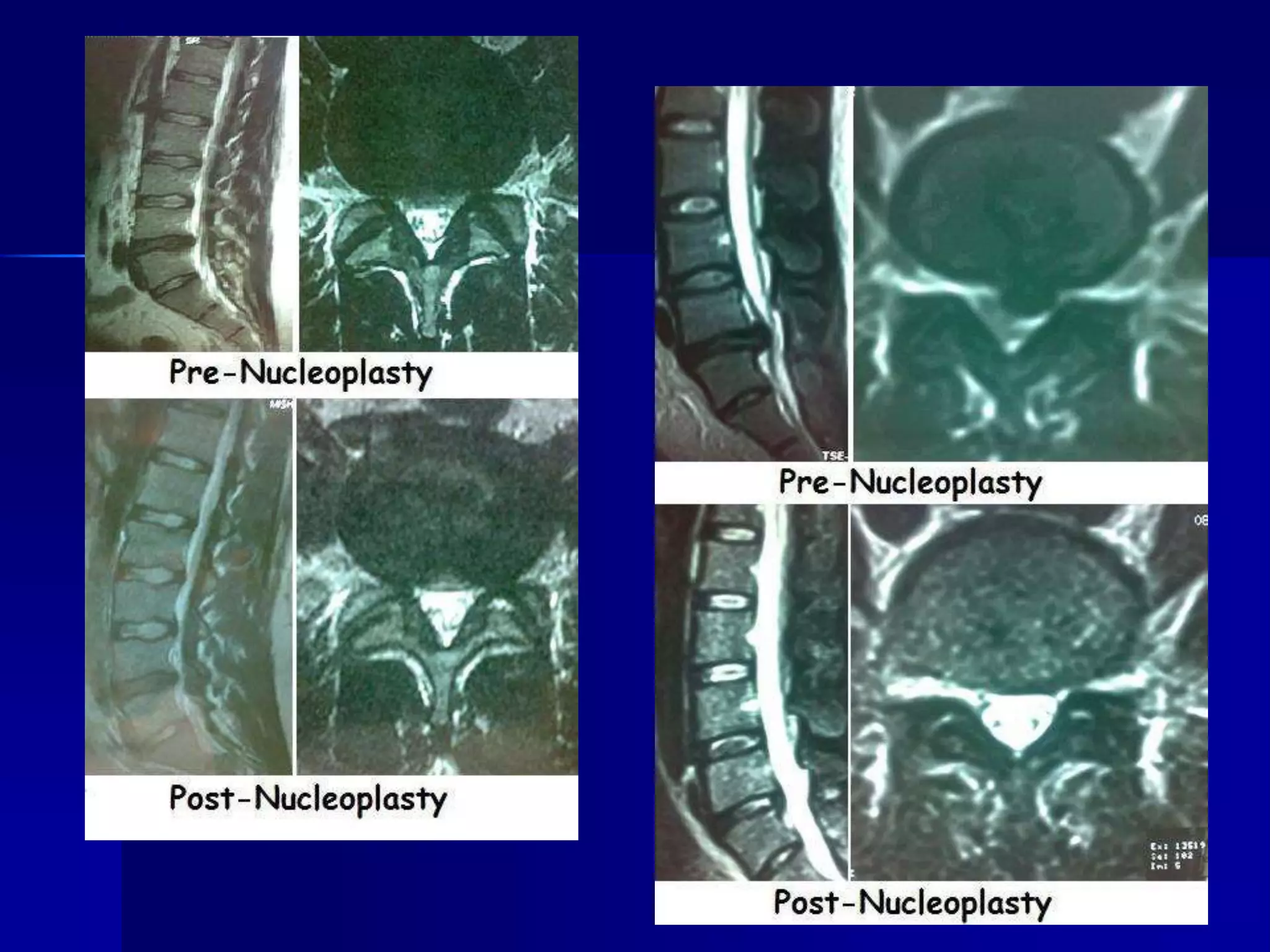 Percutaneous nucleoplasty | PPSX
