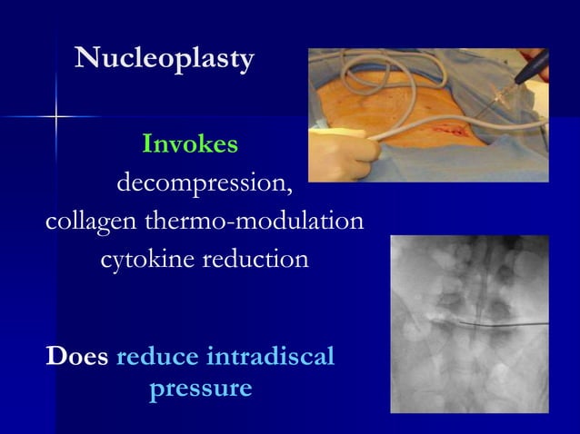 Percutaneous nucleoplasty | PPSX