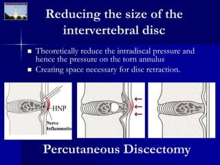 Percutaneous nucleoplasty | PPSX
