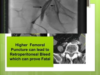 Percutaneous radial intervention dr gaurav chaudhary | PPTX
