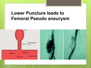 Percutaneous radial intervention dr gaurav chaudhary | PPTX