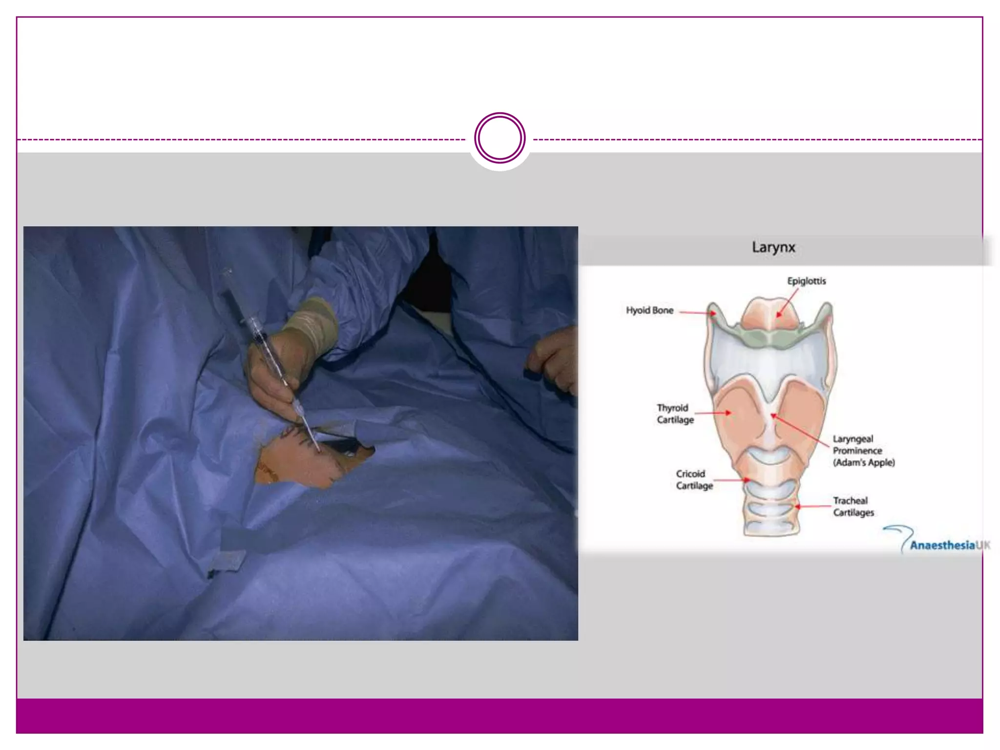 Percutaneous tracheostomy by Saja ALdulaijan | PPTX