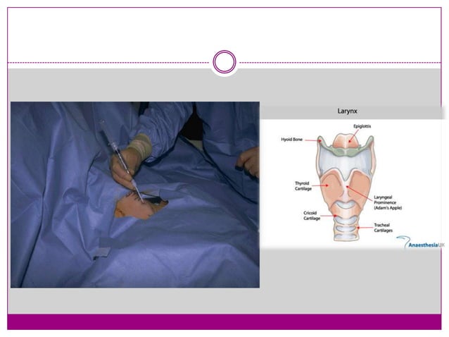 Percutaneous tracheostomy by Saja ALdulaijan | PPTX | Lung and ...