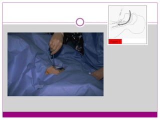 Percutaneous Tracheostomy Procedure