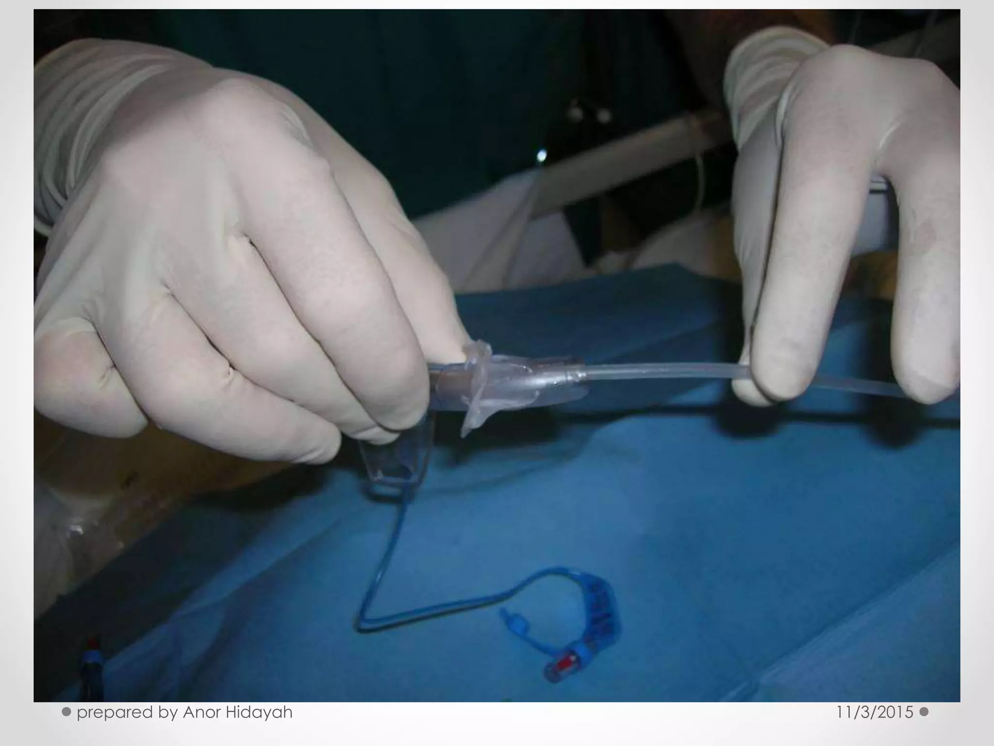 Percutaneous tracheostomy | PPTX