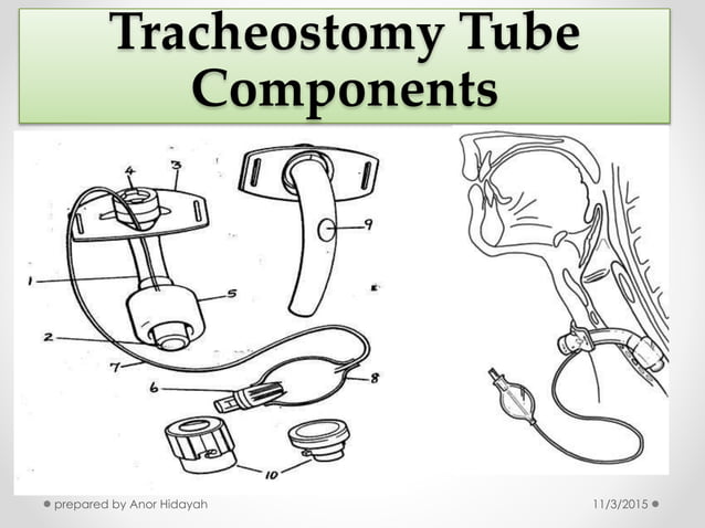 Percutaneous tracheostomy | PPTX