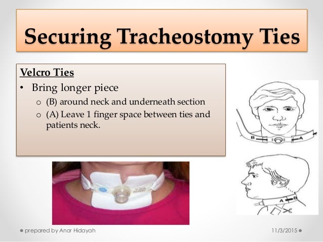 Percutaneous tracheostomy
