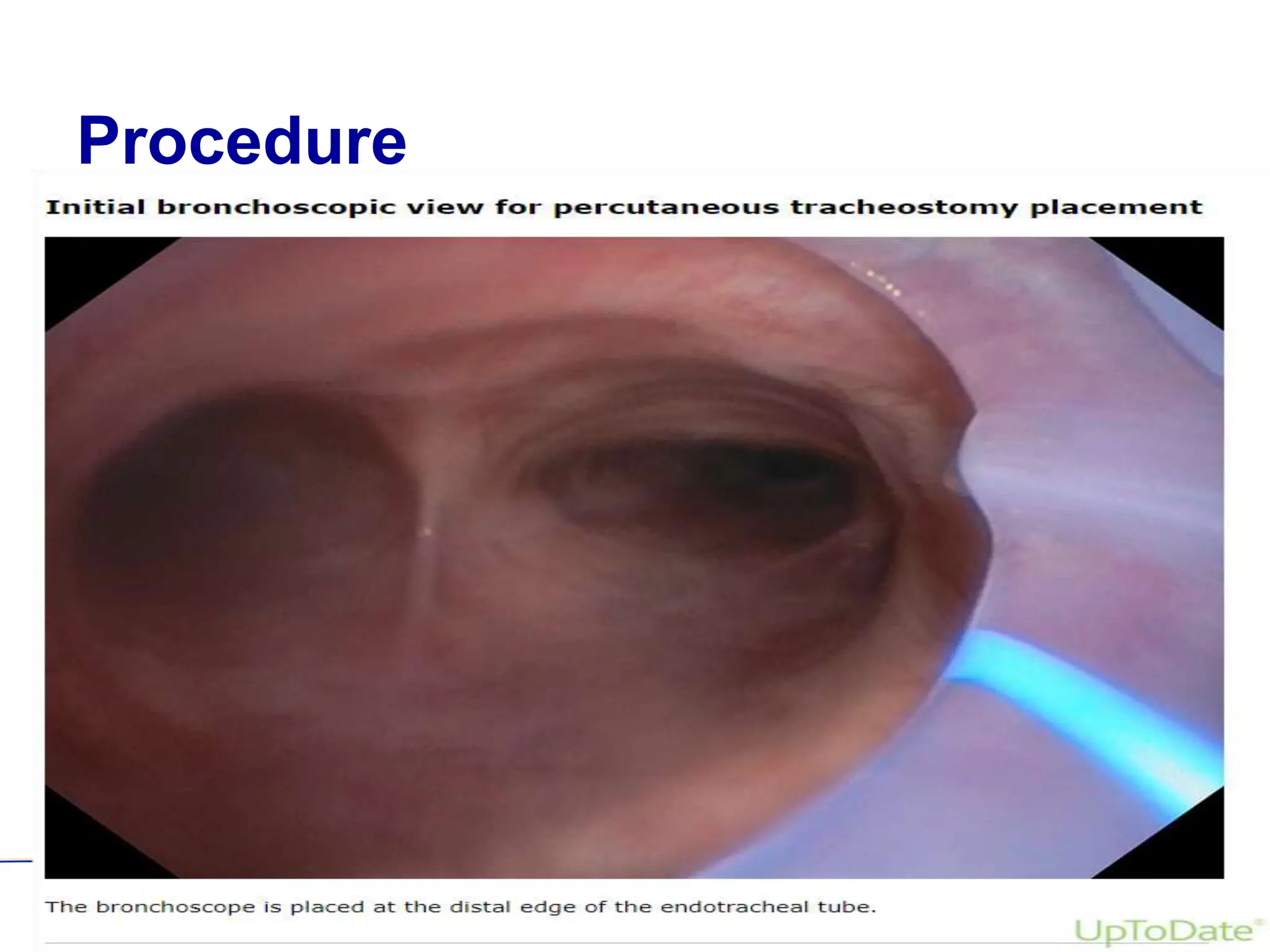 PERCUTANEOUS TRACHEOSTOMY- -NOV[1].pptx | Ear, Nose and Throat ...