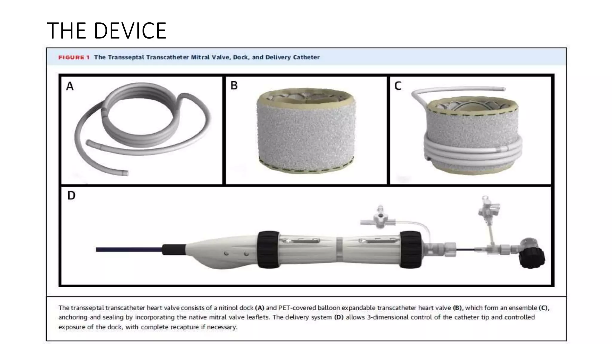 Percutaneous Transcatheter Mitral Valve Replacement | PPTX