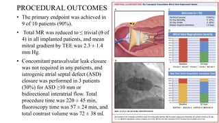 Percutaneous Transcatheter Mitral Valve Replacement | PPTX