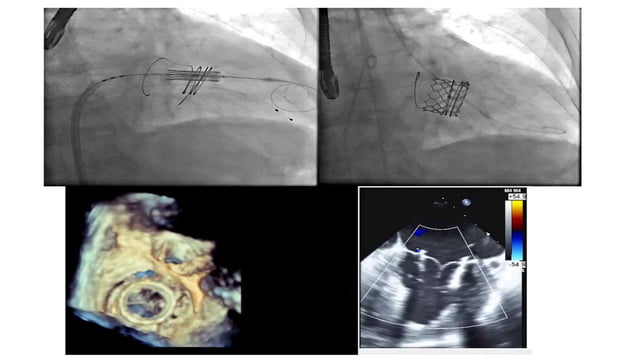 Percutaneous Transcatheter Mitral Valve Replacement | PPTX | Heart and Cardiovascular Diseases ...