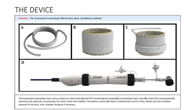 Percutaneous Transcatheter Mitral Valve Replacement | PPTX | Heart and Cardiovascular Diseases ...