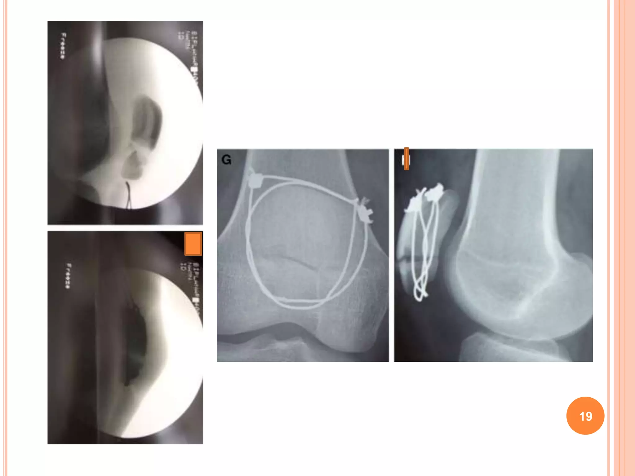 Percutaneous treatment of communited patellar fracture.pptx